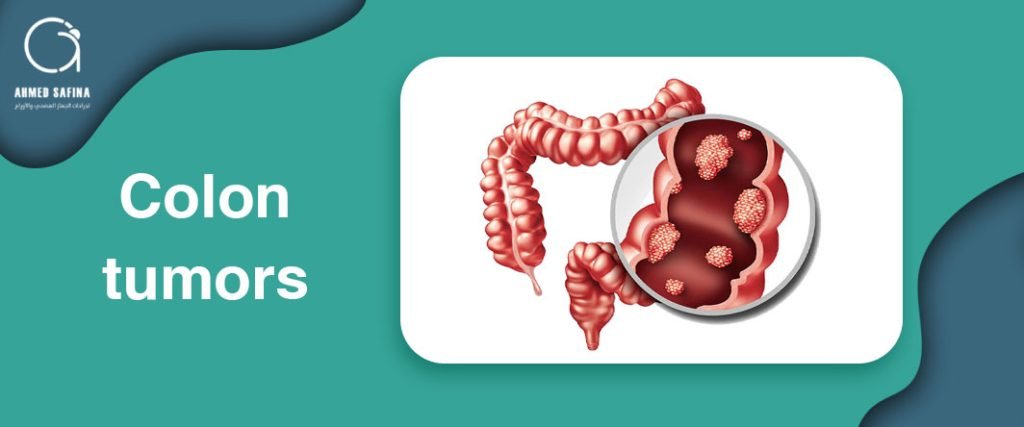 Dr.Ahmed Safina | Colon tumors
